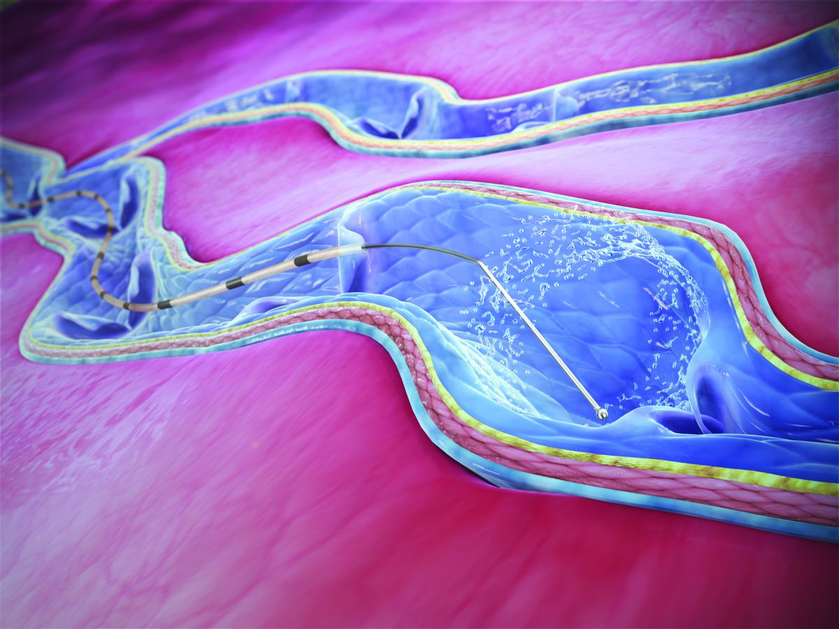ClariVein (léčba křečových žil), Varixy (křečové žíly ...